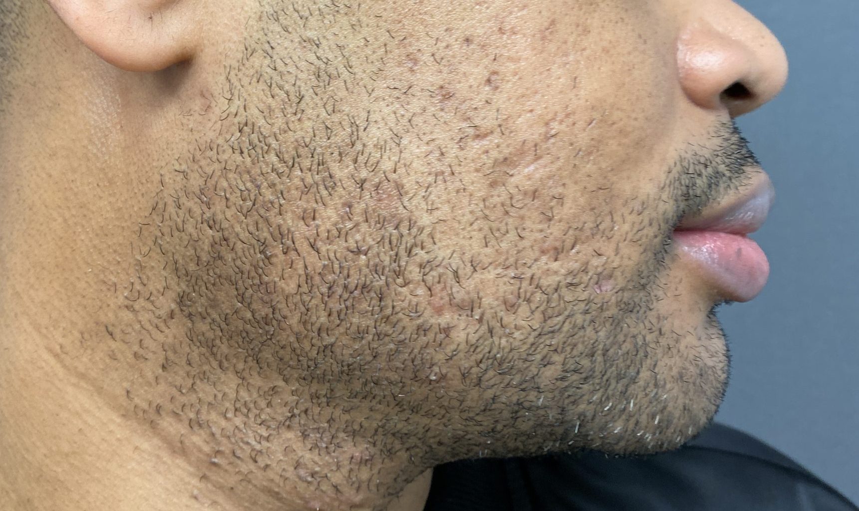 Acne Scar and Rosacea Treatment Manchester, Cheshire & Lancashire | Dr ...